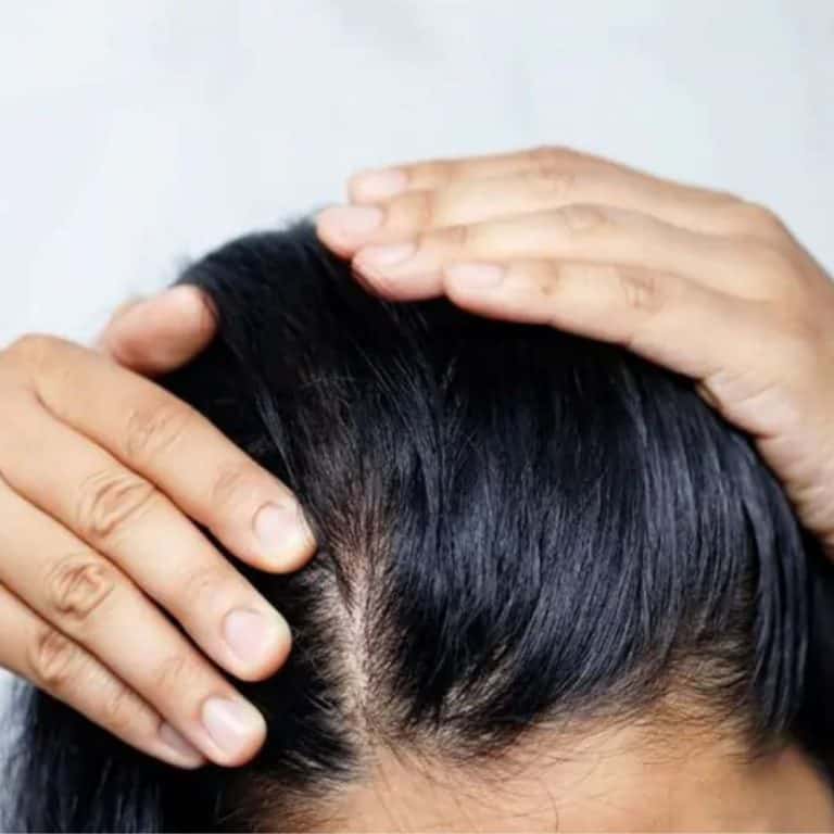 Thyroid Issues and Hair Loss: Causes, Treatments, and Regrowth Tips ...